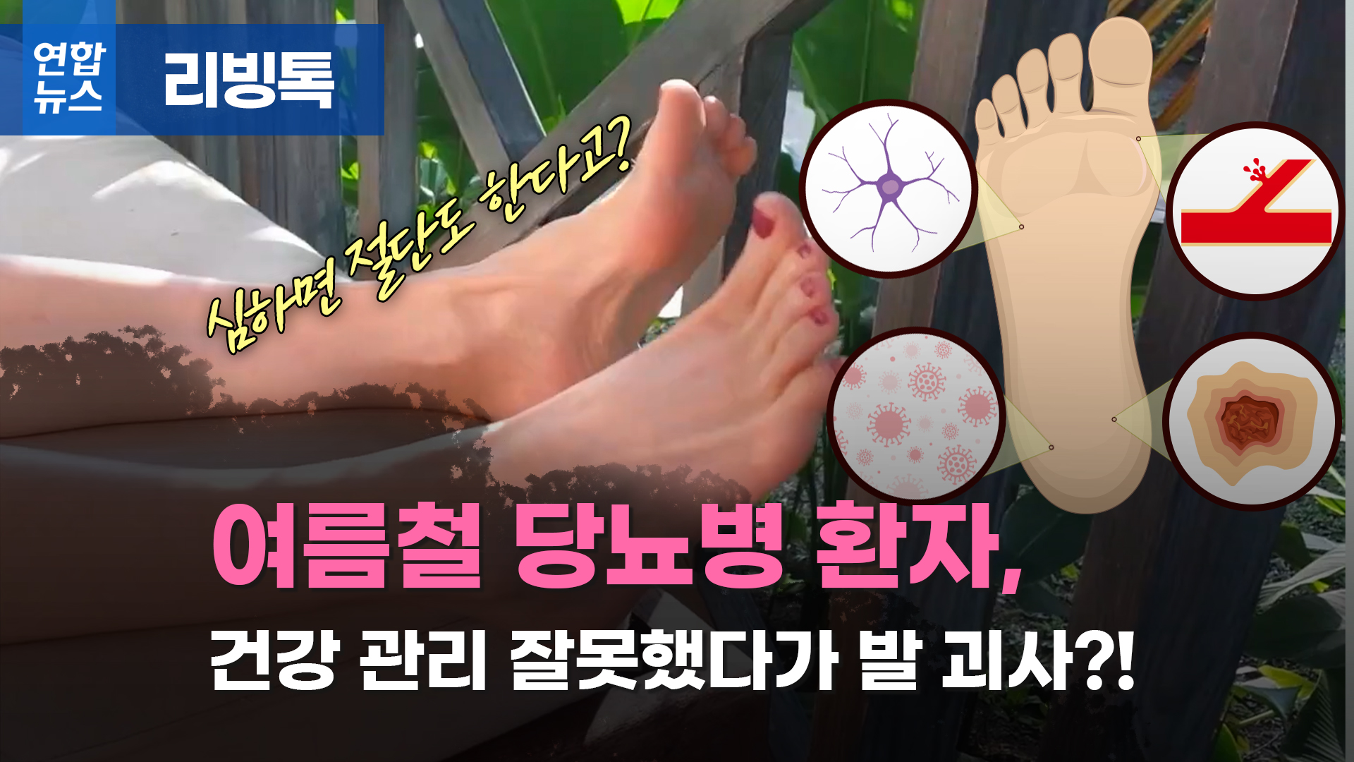 [리빙톡] 여름철 당뇨환자 특히 조심해야 할 이 합병증은 연합뉴스